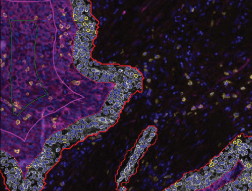 Multiplex Immunofluorescence | Precision for Medicine
