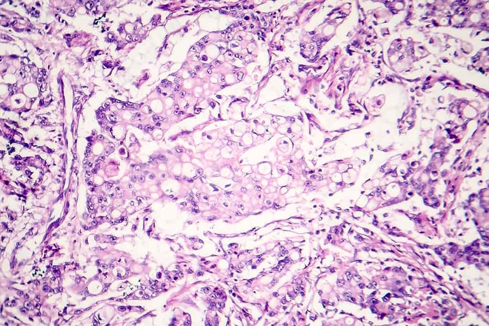 Biospecimen Therapeutic Areas | Precision for Medicine