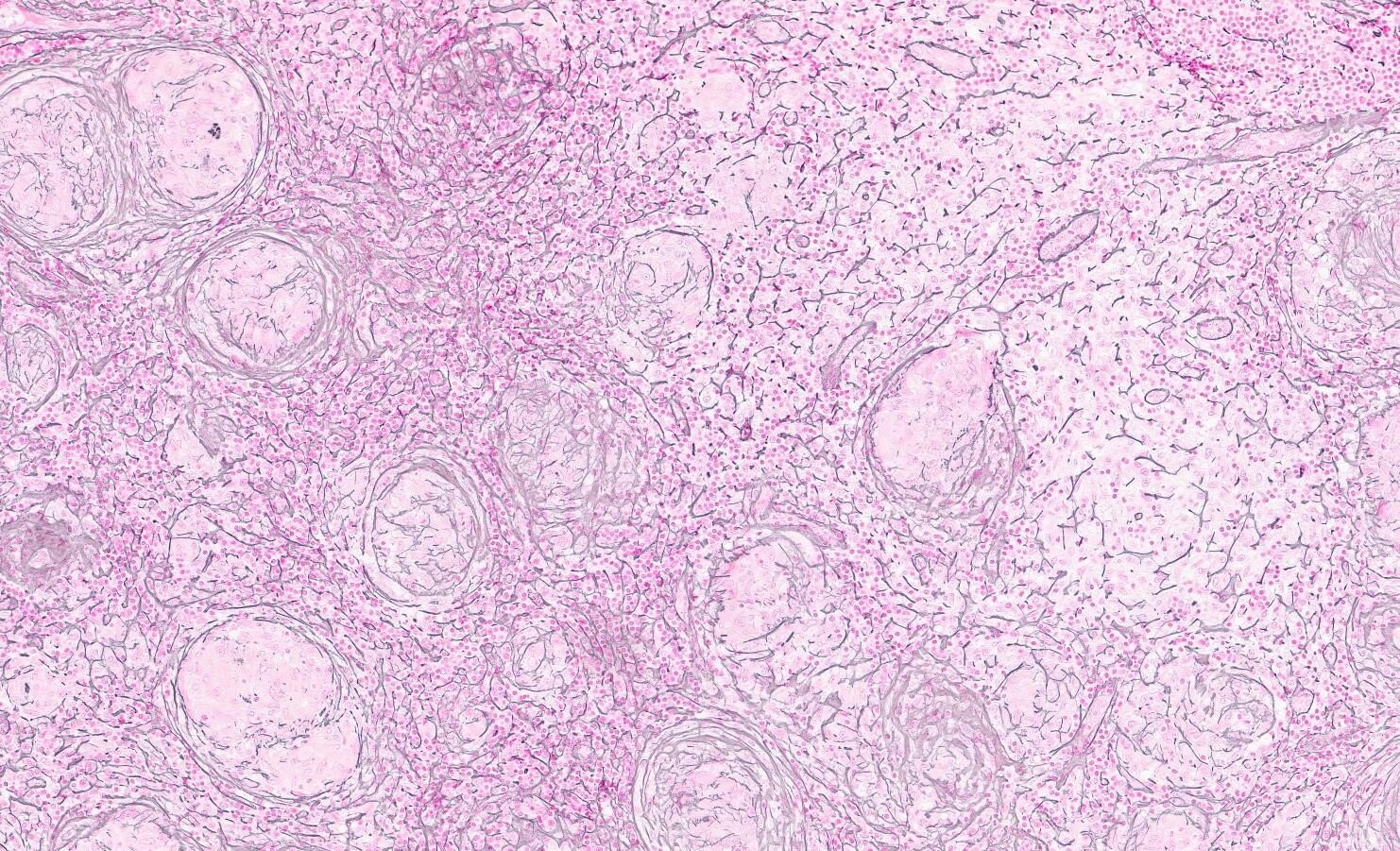FFPE Tissue Samples | Precision for Medicine