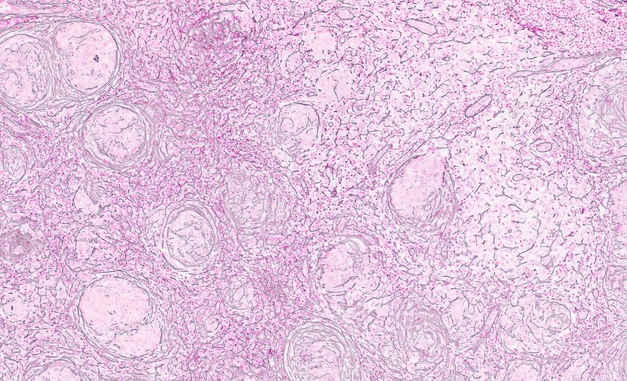 FFPE Tissue Samples | Precision for Medicine