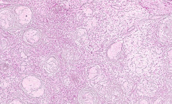FFPE Tissue Samples | Precision for Medicine